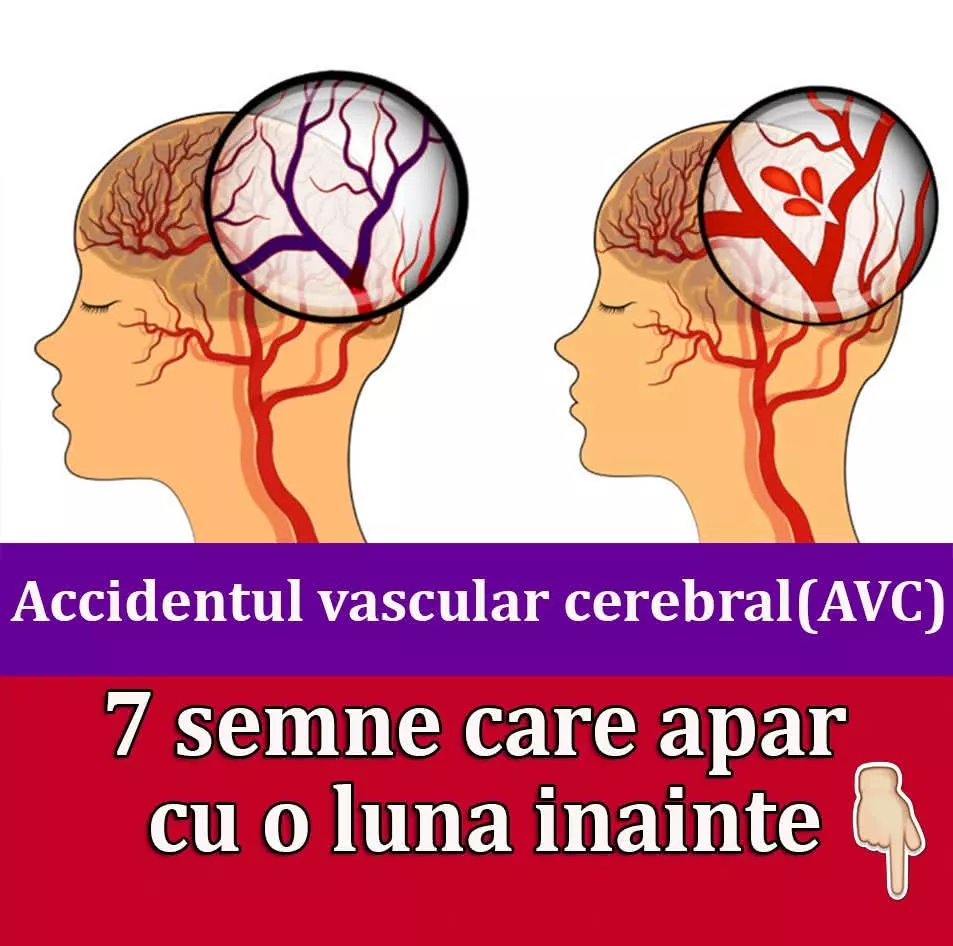 Semnalele tăcute ale unui accident vascular cerebral: simptome care pot ...